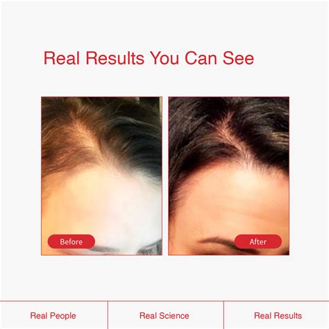 Hair Restore Shampoo Hair Restoration Laboratories Hair Restoration