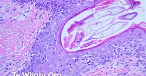 Demodicosis Pathology Image
