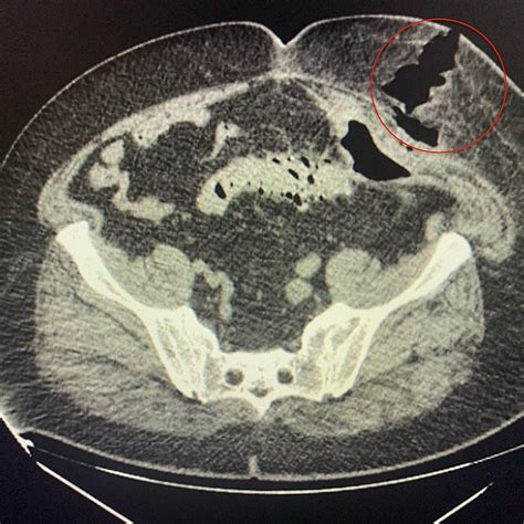 Hinchey Classification A Stage I B Stage Ii C Stage Iii D