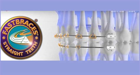 What Is Fastbraces Technology At Roxanne Corley Blog