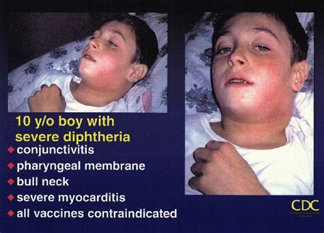 Diphtheria Symptoms Pictures