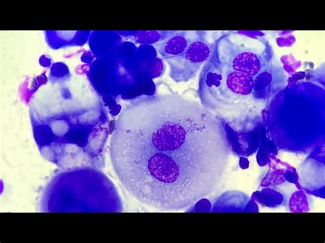 Pleural Fluid Cells Images