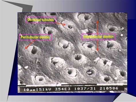 Dentinal Hypersensitivitypdf