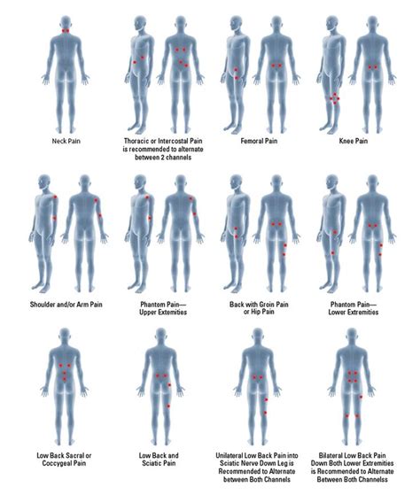 Tens Electrode Placement Chart Tens And Units Tens Electrode