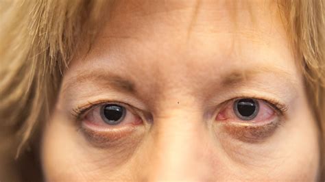7 Things You Dont Know About Dilated Pupils That Could Lead To A Scary
