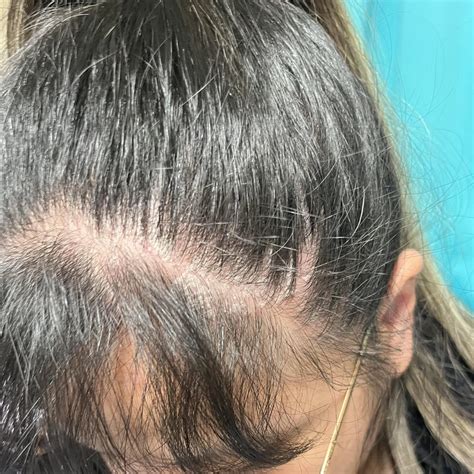 Doctor Kept Saying Its Just Dry Scalp Is It Actually Just Dry Scalp