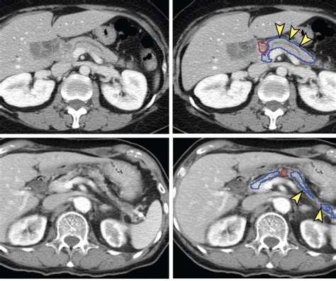 Could A New Deep Learning Tool Enhance Ct Detection Of Pancreatic Cancer