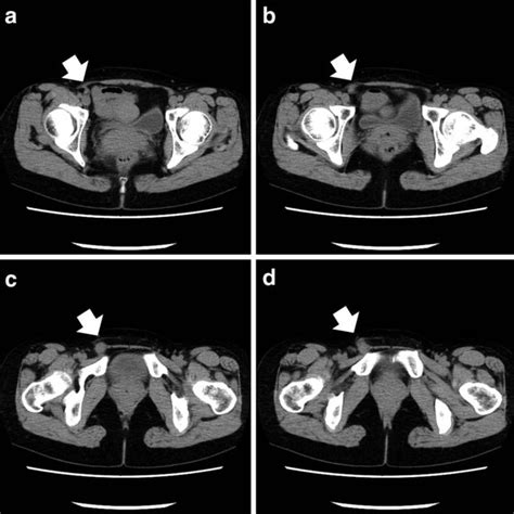 Pelvic Ct Axial An Approximately 18×16 Mm Soft Tissue Structure With
