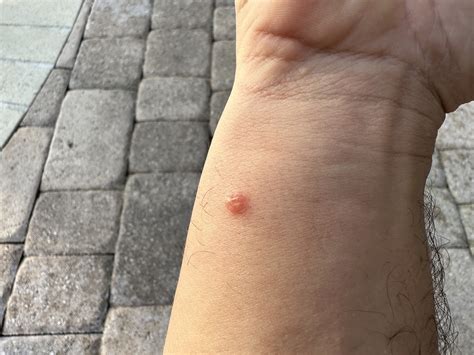 Shared Post Bug Bite Dont Worry Not Gross