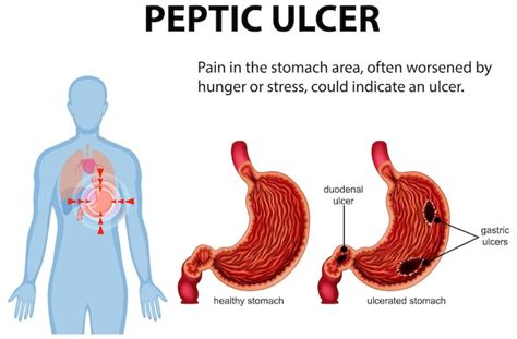 What Causes Chronic Peptic Ulcers