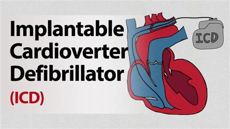 Implantable Cardioverter Defibrillator Icd Youtube
