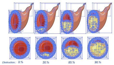 Atheroma Obstruction Vector