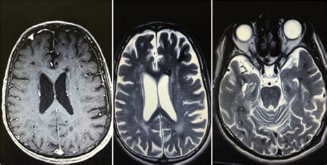 Cerebral Cavernomatosis