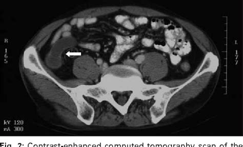 Appendix Mucinous Cystadenoma Semantic Scholar
