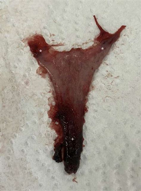 A Rare Case Of En Bloc Endometrium Shedding Isge