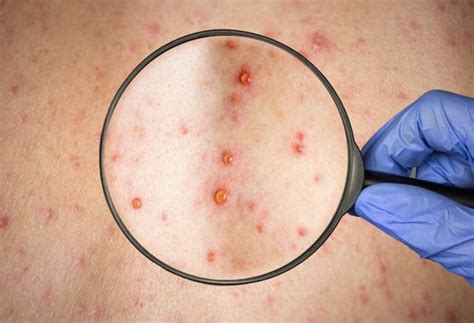 Buy Valtrex Online For Shingles Herpes Simplex Virus Genital Herpes
