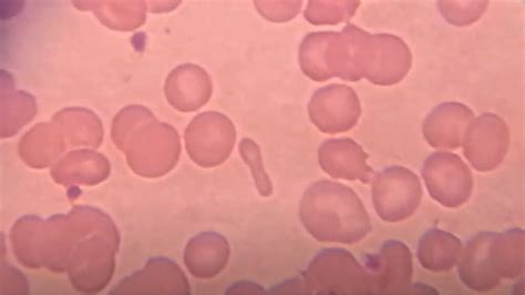 Rbc Morphology Introduction Types Clinical Significance