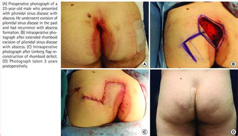 Patient With Pilonidal Sinus Disease With Abscess Download Scientific