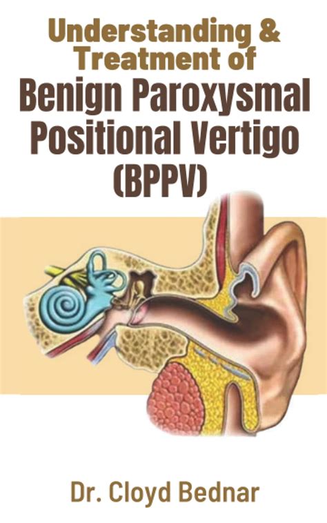 Buy Understanding And Of Benign Paroxysmal Positional Bppv Symptoms Causes Management S And