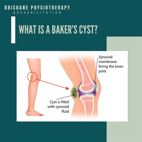 Bakers Cyst What Is A Baker Knee Cyst Symptoms And Treatment