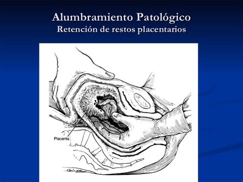 10 Puerperio Patológico
