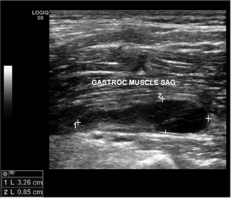 Gastrocnemius Tear Ultrasound Radiology
