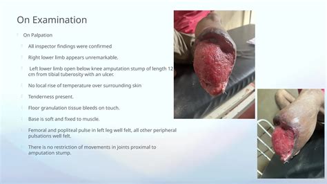 A Case Of Below Knee Amputation Gmc Pptx