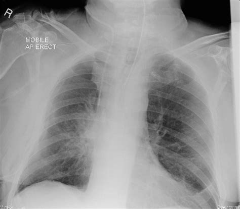 The First Post Operative Chest Radiograph Performed Within Hours Of