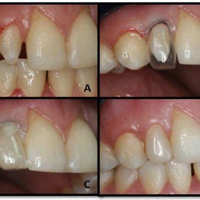 Pdf Treatment Approach For Restoring The Peg Shaped Incisors