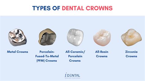 Dental Crown In Singapore Types Benefits And Prices Idental