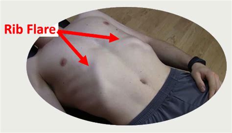 Rib Flare Meaning What Causes Rib Flare Nzhgk