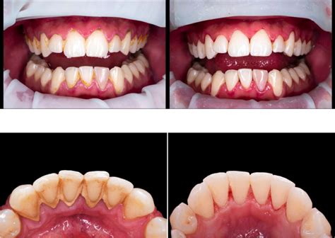 Teeth Deep Cleaning Before And After