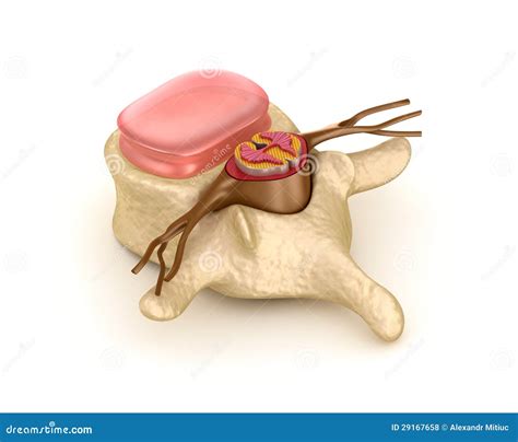 Spinal Disk Herniation Vector Medical Scheme 121071375