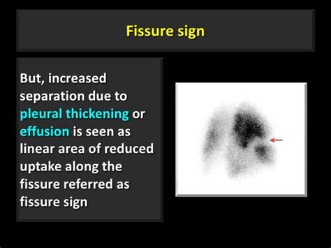 Figure 3 Sign Fleischner Sign Fissure Sign Headcheese Sign Hilar Over…