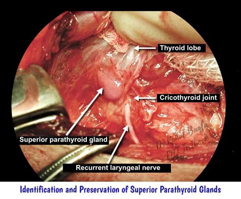 Parathyroid Gland Surgery Head And Neck Tumors Parathyroid — Dr