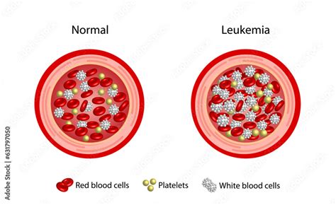 Leukemia Blood Cancer Difference Between Healthy Normal Blood And