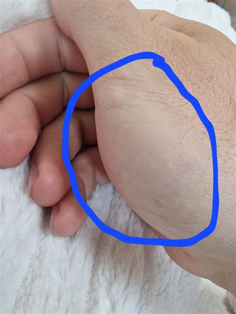Is This A Hiv Rash Also Have Athletes Foot Rhiv