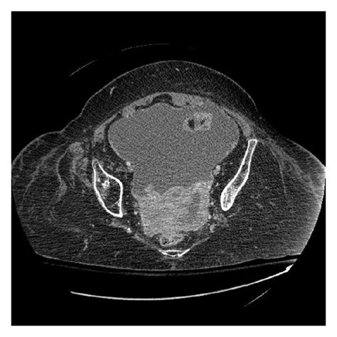 Ct Scan Of The Abdomen And Pelvis Shows Ascites Nodularity In The