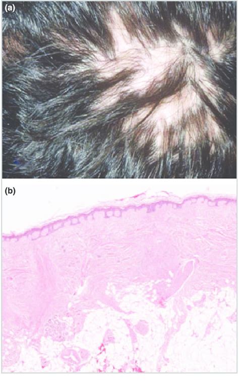 Pseudopelade Of Brocq A Characteristic Noninflamed Irregular Patch Download Scientific