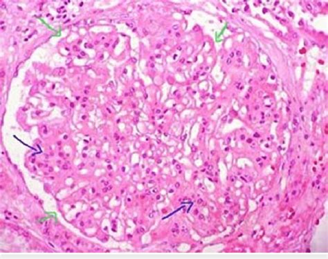 Histopathology Report Of Renal Biopsy Light Microscopy The Image Download Scientific Diagram