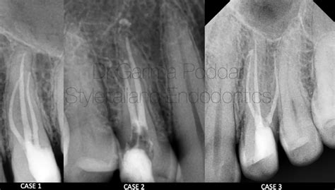 Maxillary 1st Premolar