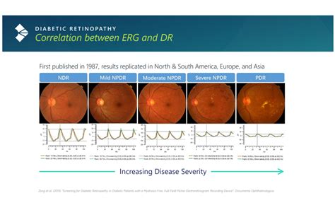 Electroretinography Added To Aaos Diabetic Retinopathy Preferred