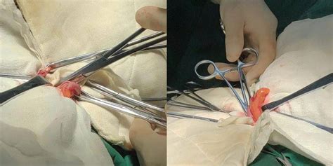 【同仁精品外科—阑尾切除术】李晓奇主任治疗急性阑尾炎临床