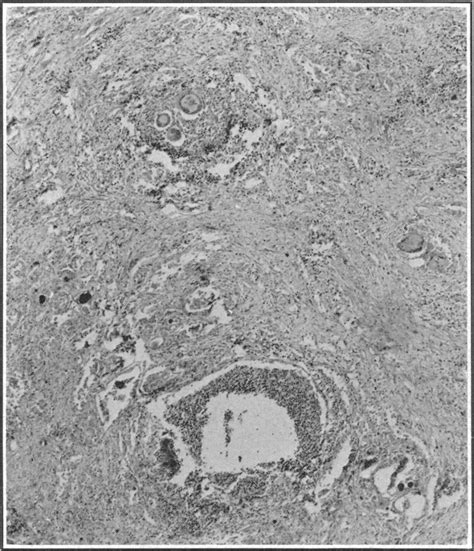 Chronic Thyroiditis Nejm