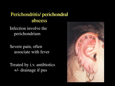 Ppt Diseases Of External Ear Powerpoint Presentation Free Download