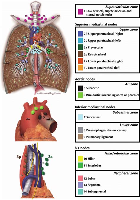 Tcancer Lymph Node Mapping