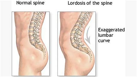 Swayback Posture Causes Treatment Exercises More