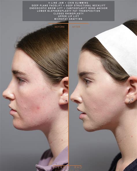 Jaw Reduction V Line Slimming In Washington Dc Sherber Rad
