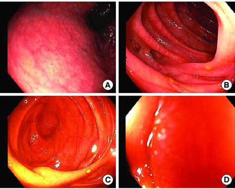 Colonoscopic Images Showing Rectum A Sigmoid Colon With Download Scientific Diagram