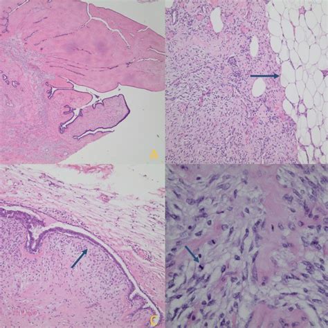 Histological Findings Of Lumpectomy Of The Borderline Phyllodes Tumor Download Scientific